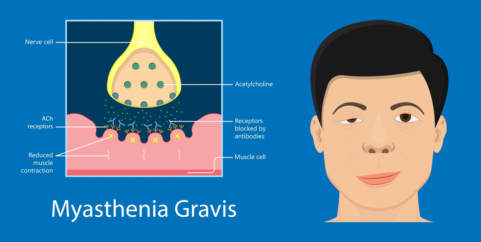 MYASTHENIA GRAVIS & BENEFITS - Cannon Disability Law