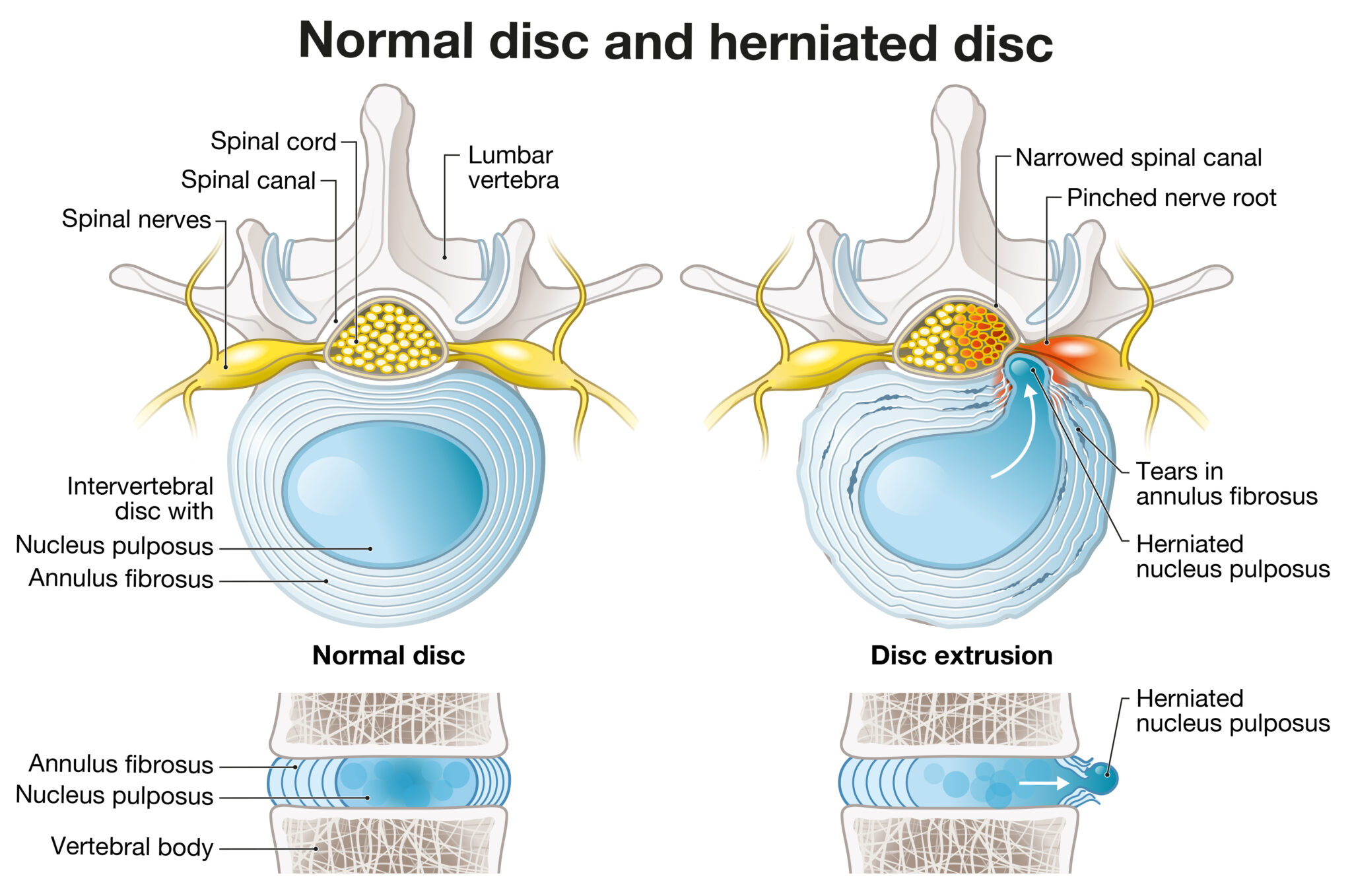 SSD BENEFITS FOR HERNIATED OR BULGING DISCS - Cannon Disability Law